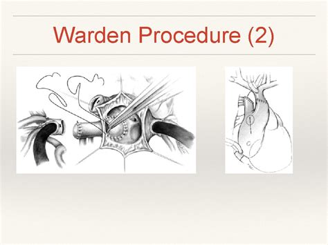 Ucsf Congenital Cardiac Anesthesia Tutorials Vsds And Asds