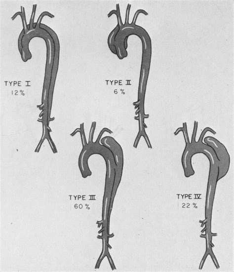 The Development Of The Debakey Classification Of Aortic Dissection