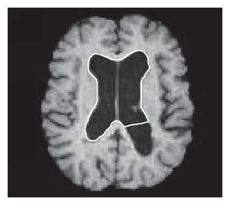 A Medical Image With Initial Contour And Convergences Of B Gvf Download Scientific Diagram
