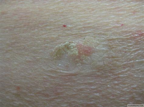 Benign Skin Lesions Keratosis