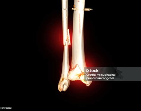 Ct 스캔 발목 관절 골절 경골 및 비골 뼈를 보여주는 3d 렌더링 이미지 3d 스캔에 대한 스톡 사진 및 기타 이미지 3d 스캔 3차원 형태 Cat 스캔 Istock