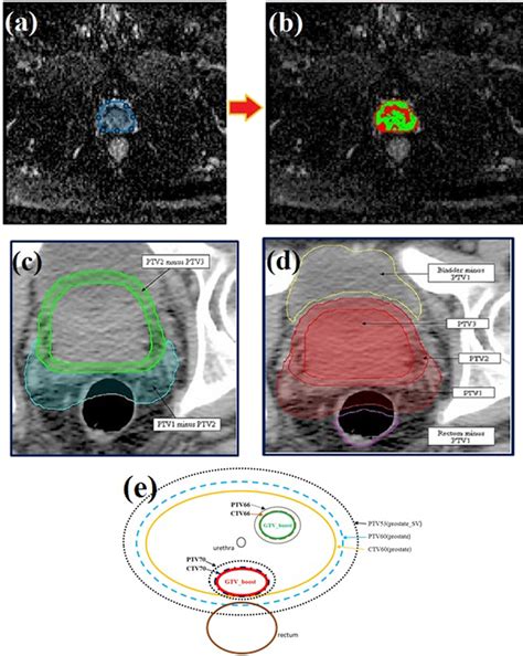 The Procedure Used To Automatically Contour The Intraprostatic Dose Download Scientific Diagram