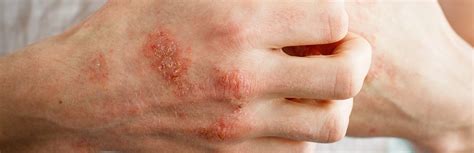 Effective Eczema Treatment In Calicut Expert Solutions Aluer Aesthetics