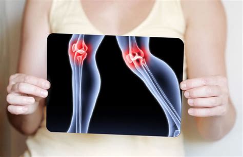 Exploring Knee Osteoarthritis Stages Medial Compartmental Oa And The