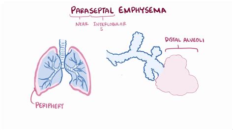 Emphysema Histology Comparison