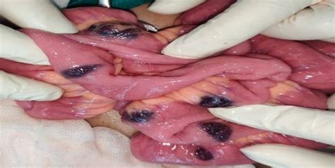 Intra Operative Finding Of 6 Lesions In Terminal Ileum Download