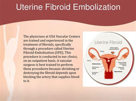 Ppt Non Surgical Uterine Fibroids Treatment Usa Vascular Centers