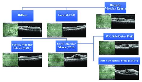 Classification Of Diabetic Macular Edema The Representative Case Download Scientific Diagram