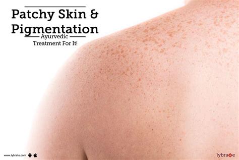 Patchy Skin And Pigmentation Ayurvedic Treatment For It By Dr Meenu Dwivedi Lybrate