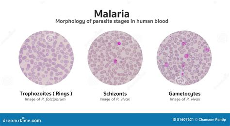 What Does Malaria Look Like Under A Microscope