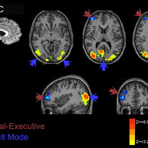 Posteromedial Cortex Connectivity Comparison Of Late Preterms Versus Download Scientific