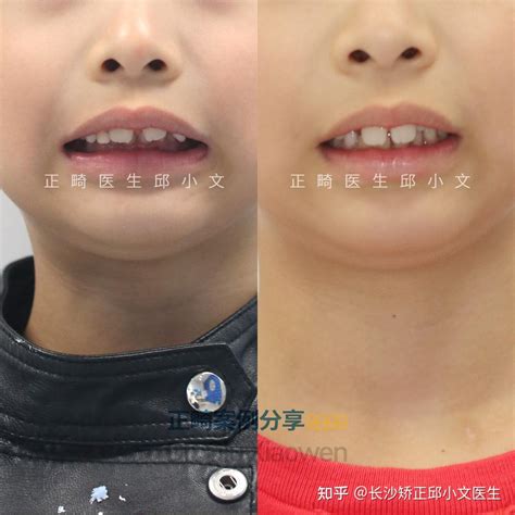 邱小文正畸案例集：7岁小男孩，下颌后缩，通过罗慕早期干预矫治，导下颌往前 知乎