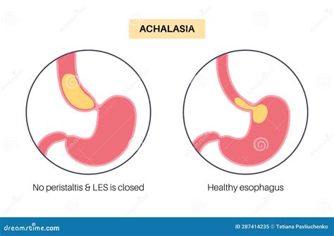 Esophageal Achalasia Disease Cartoon Vector 287414235