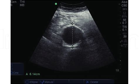 Pocus Demonstrating An Abdominal Aortic Aneurysm Measuring 6 Cm Download Scientific Diagram