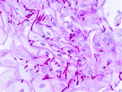 Candida Albicans Infectious Dis Medbullets Step 23