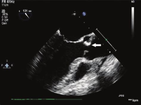 Two Dimensional Echo Showing Vegetation On Bicuspid Aortic Valve Arrow Download Scientific