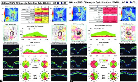A And B Digital Hd Oct Scan Of The Onh And Rnfl Depicting Bilateral Download Scientific