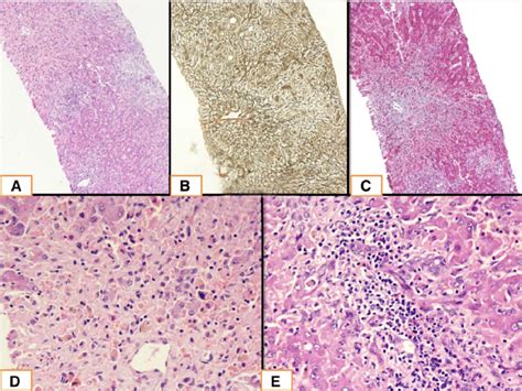 Photomicrograph Of Post Mortem Liver Biopsy Specimen Of Patient With Download Scientific