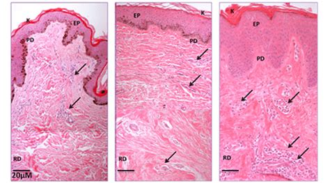 Hypertrophic Vs Keloid Scar