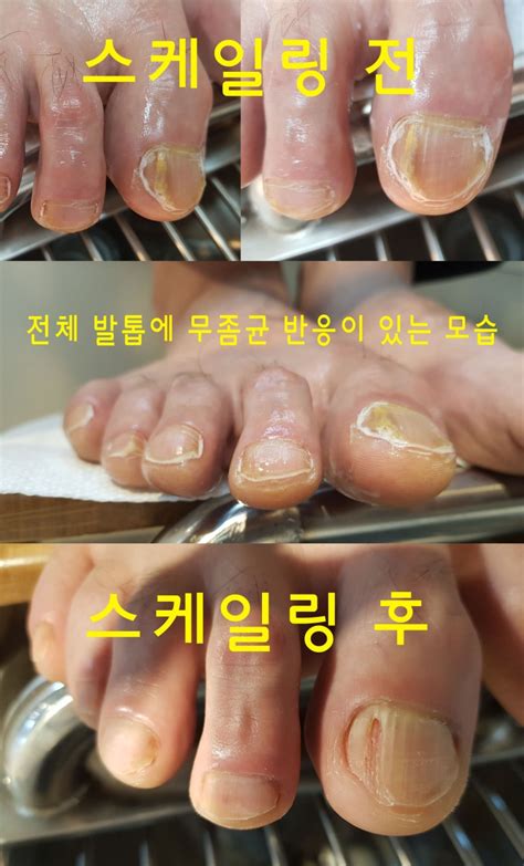 무좀발톱 내성발톱 무좀약 Band