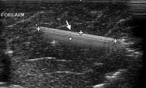 Longitudinal Sonogram Shows A Hyperechoic 5 Cm Long Broken Glass Download Scientific Diagram