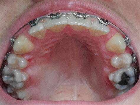 Expander Before And After I Loved My Expander Experience Tbh R Braces