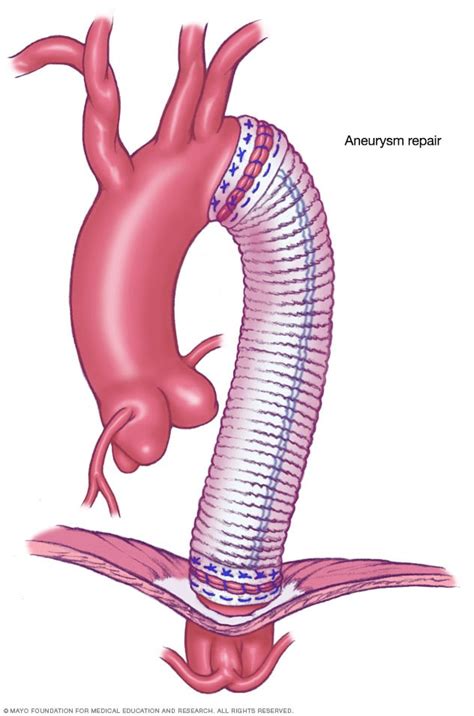 Thoracic Aortic Aneurysm Diagnosis And Treatment Mayo Clinic