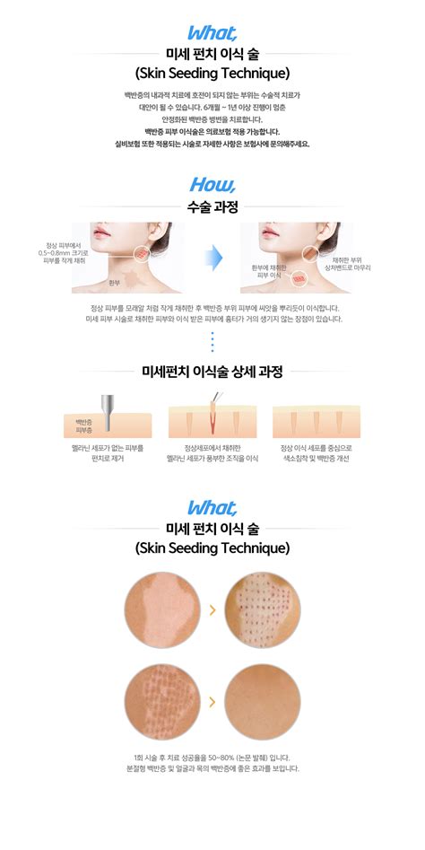 진주 미피부과성형외과 백반증 외과적 치료