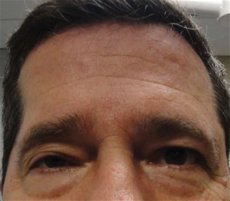 Differentiating Trigeminal Motor Neuropathy And Progressive Hemifacial