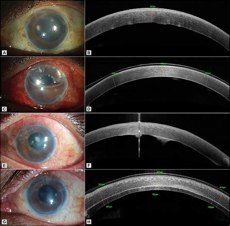 Delayed Postoperative Interface Keratitis Due To Enterococcus Faecalis