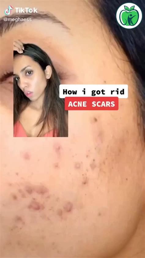 How To Get Rid Of Acne Scars Best Skin Care Products Artofit