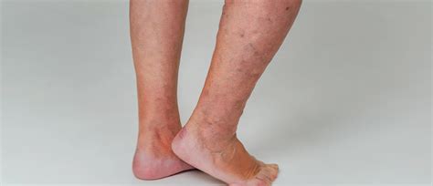 Tromboflebite Vascular Atibaia