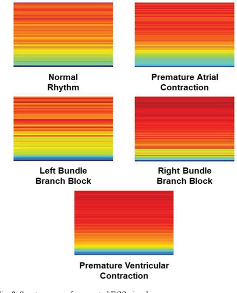Figure 1 From Arrhythmias Classification By Using Stft Based