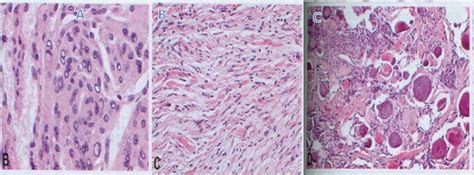 Diagnosis And Grading Of Meningiomas Intechopen