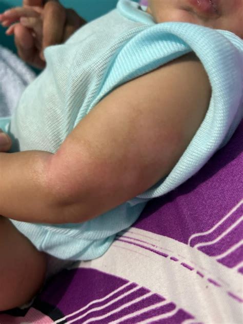 Infeksi Kulit Hellosehat