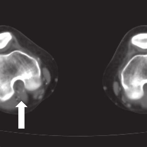 Intermittent Claudication Pain Scale Download Table
