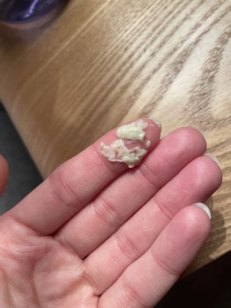 What Does Normal Discharge Look Like During Pregnancy