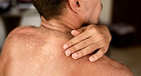 Part 4 Scientific Sunburn And Skin Cancer Open Access Government