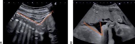 Methodology And Utility Of Intrapartum Ultrasound Clínica E
