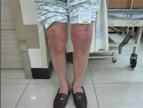 Өвдөгний үе солих мэс засал