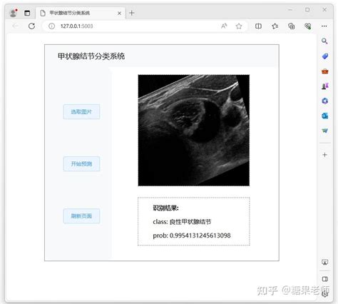 深度学习之基于resnet50卷积神经网络甲状腺结节分类识别系统 知乎
