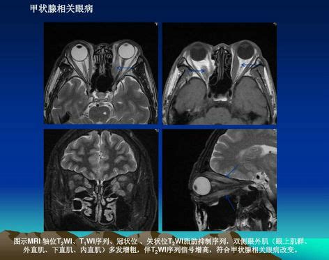 眼眶疾病的影像诊断中国眼科网