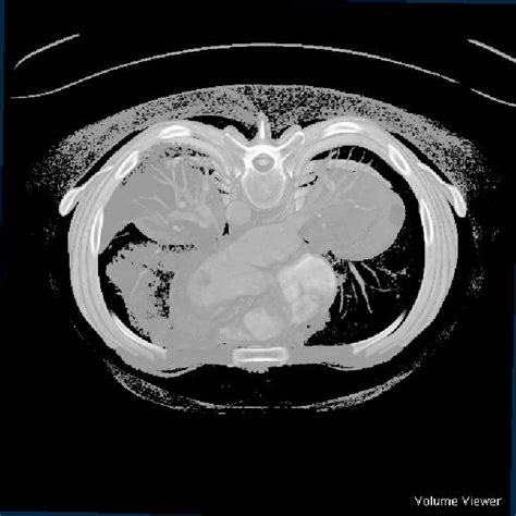 Imagej Application Displaying Overhead View Of A Ct Of The Abdomen