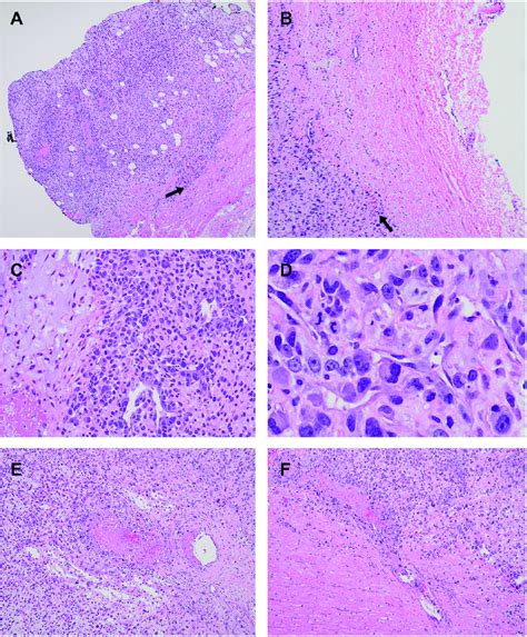 Hematoxylin And Eosin Stained Histopathologic Sections Of The Intimal