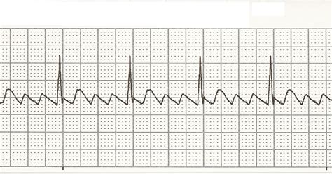 A Flutter Ekg Gulfbabe