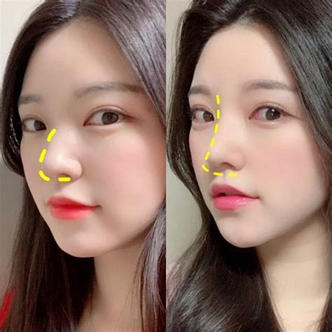 Thermoplastic Nasal Splint Self Shaping Nose Clip Low Temperature