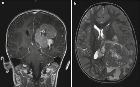 Choroid Plexus Tumors Oncohema Key