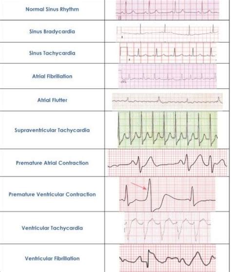 Schemes Set Of Common Electrocardiogram Ecg 43 Off