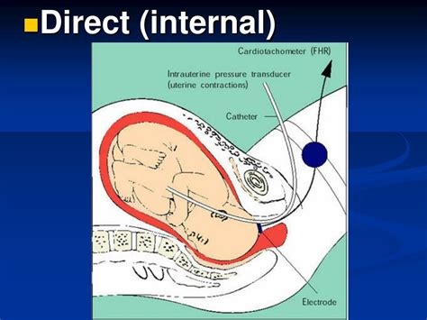 PPT Cardiotocography CTG Electronic Fetal Monitoring PowerPoint Presentation ID