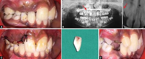 Supernumerary Teeth Extraction